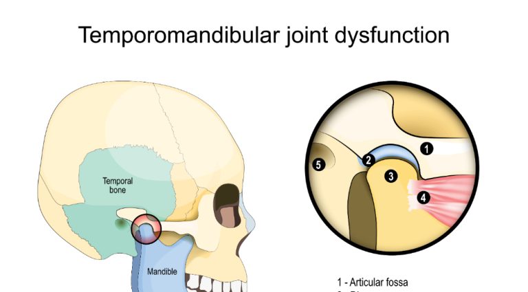 TMJ Articular Disc Perforation: What You Need to Know | Sleep & TMJ Therapy